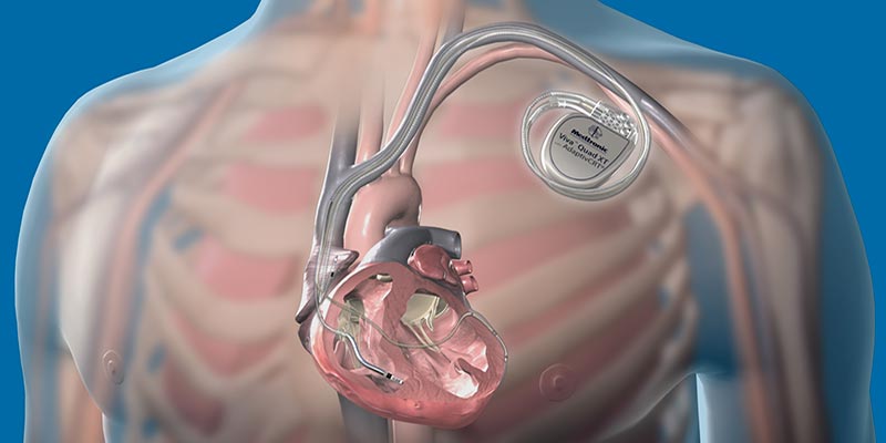 Avis aux patients porteurs des pacemakers Medtronics